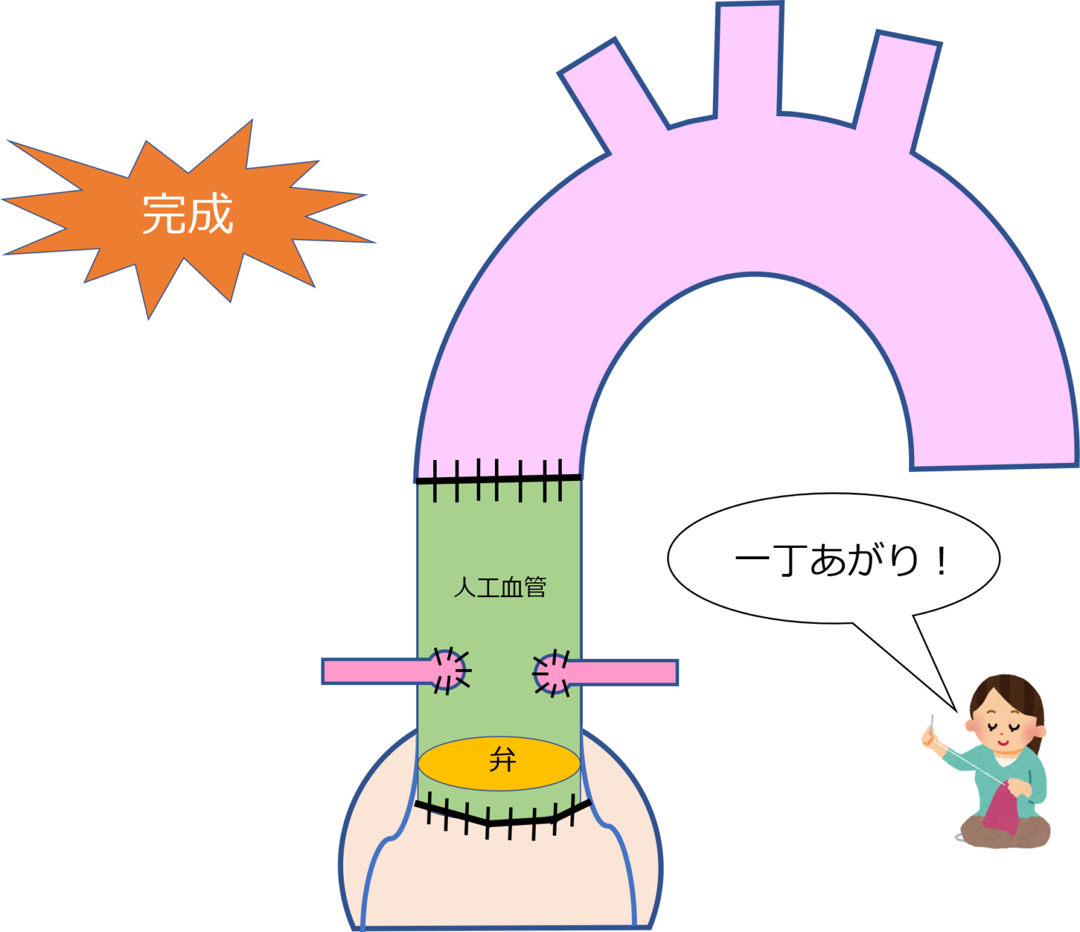 大動脈基部置換術 ～ベントール後の看護のポイント～ | ICU看護師ダンカンの心外ブログ