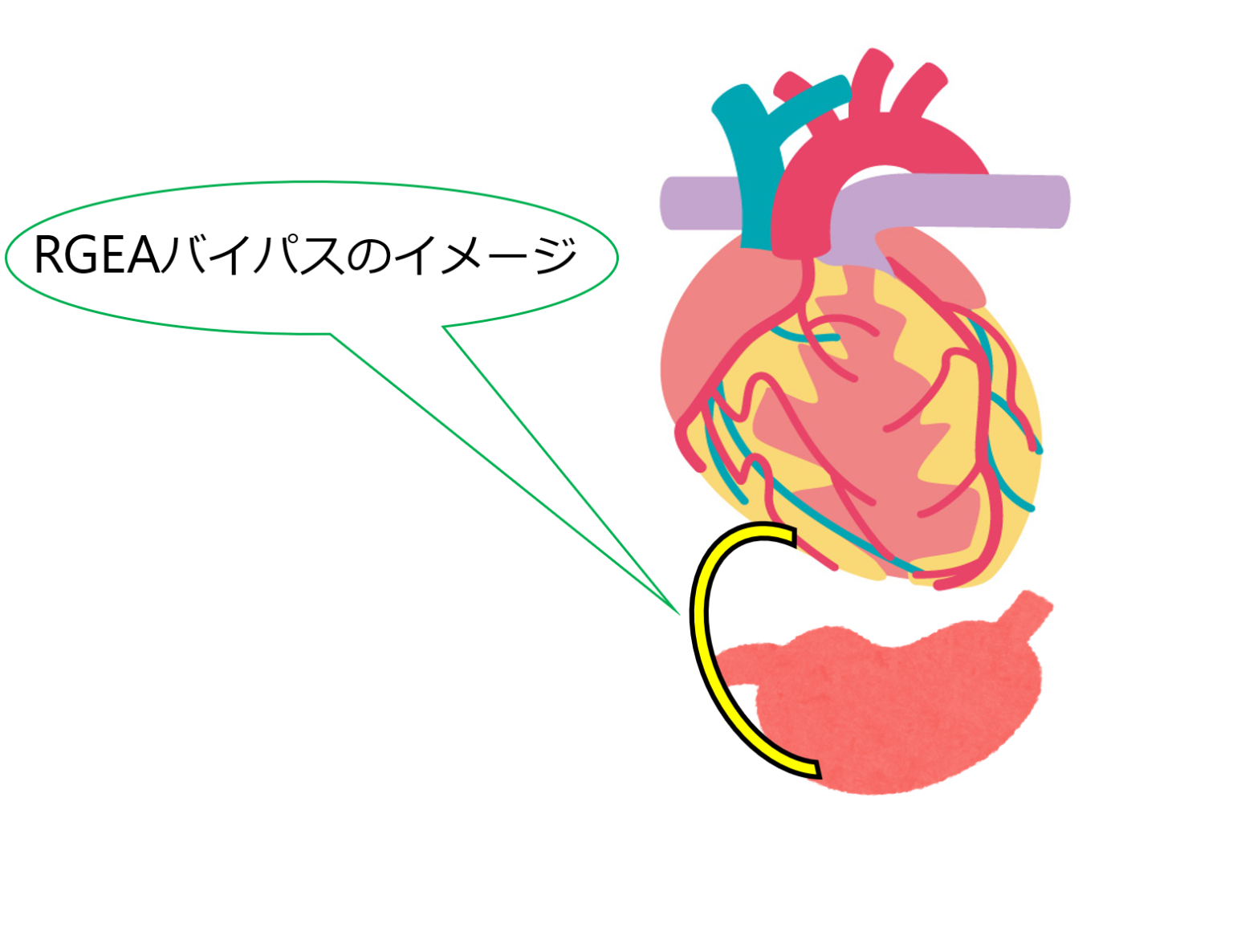 CABG（冠動脈バイパス術）パート① ～各グラフトの特徴＆術式の種類を解説～ | ICU看護師ダンカンの心外ブログ