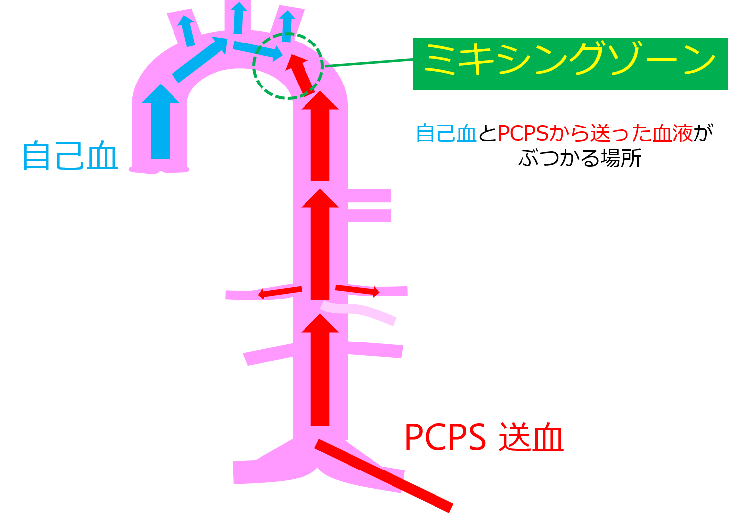 PCPS（VA‐ECMO）装着中の看護 Vol.2 | ICU看護師ダンカンの心外ブログ