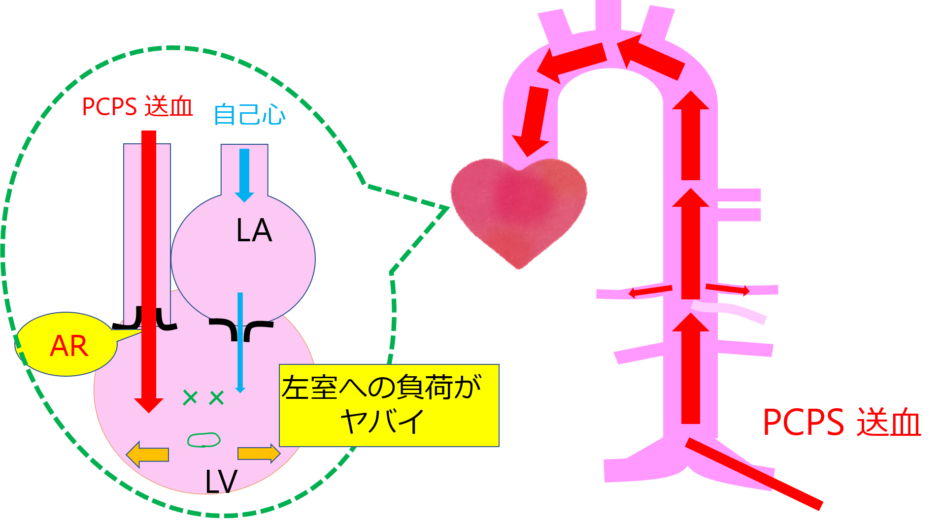 PCPS(VA‐ECMO)回路の観察ポイント ～安全に看護するためにPCPSを知ろう編～ | ICU看護師ダンカンの心外ブログ