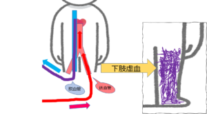 PCPS（VA‐ECMO）装着中の看護 Vol.2 | ICU看護師ダンカンの心外ブログ