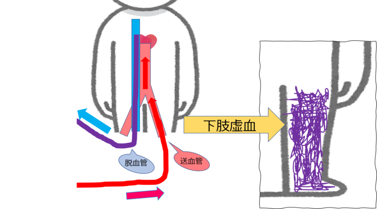 PCPS(VA‐ECMO)回路の観察ポイント ～安全に看護するためにPCPSを知ろう編～ | ICU看護師ダンカンの心外ブログ