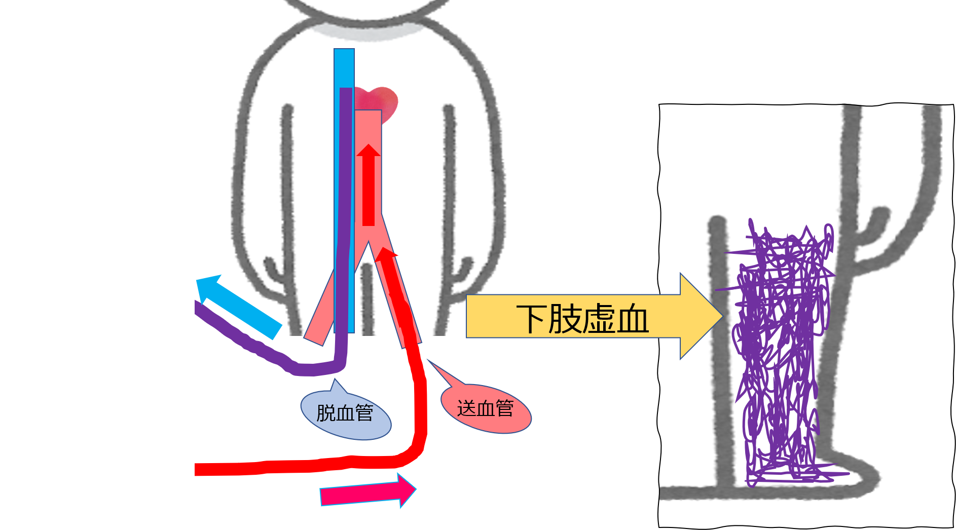 PCPS(VA‐ECMO)回路の観察ポイント ～安全に看護するためにPCPSを知ろう編～ | ICU看護師ダンカンの心外ブログ