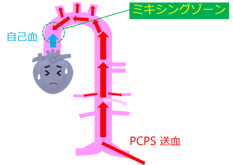 PCPS（VA‐ECMO）装着中の看護 Vol.2 | ICU看護師ダンカンの心外ブログ