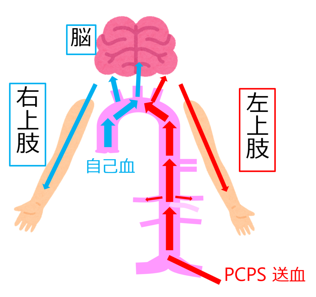 PCPS（VA‐ECMO）装着中の看護 Vol.2 | ICU看護師ダンカンの心外ブログ