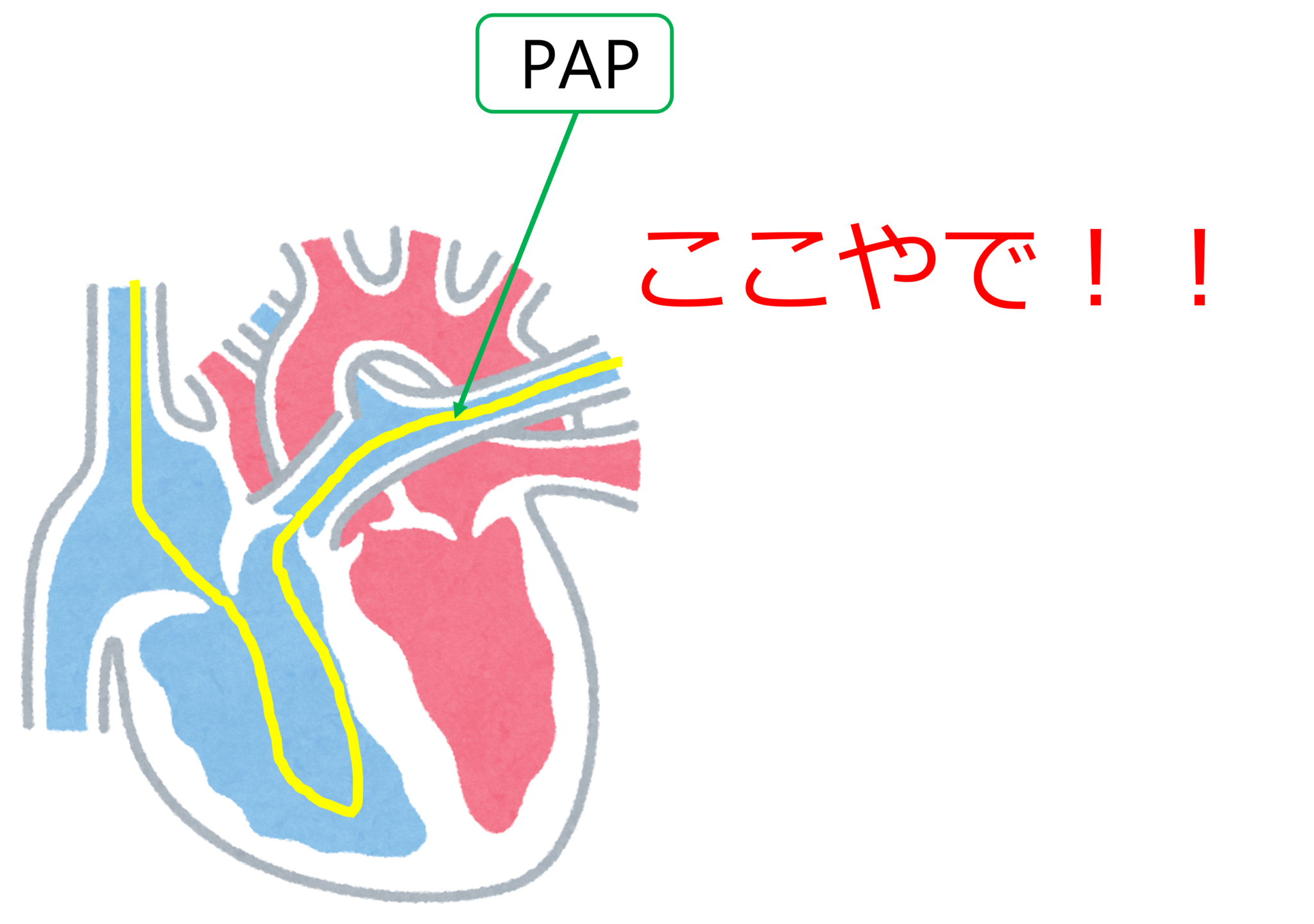 スワンガンツカテーテル（肺動脈カテーテル）挿入中の看護 ～注意点・管理のポイント～ | ICU看護師ダンカンの心外ブログ
